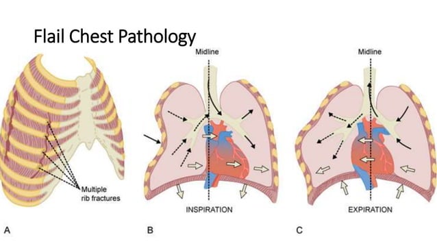Chest Injuries.pptx