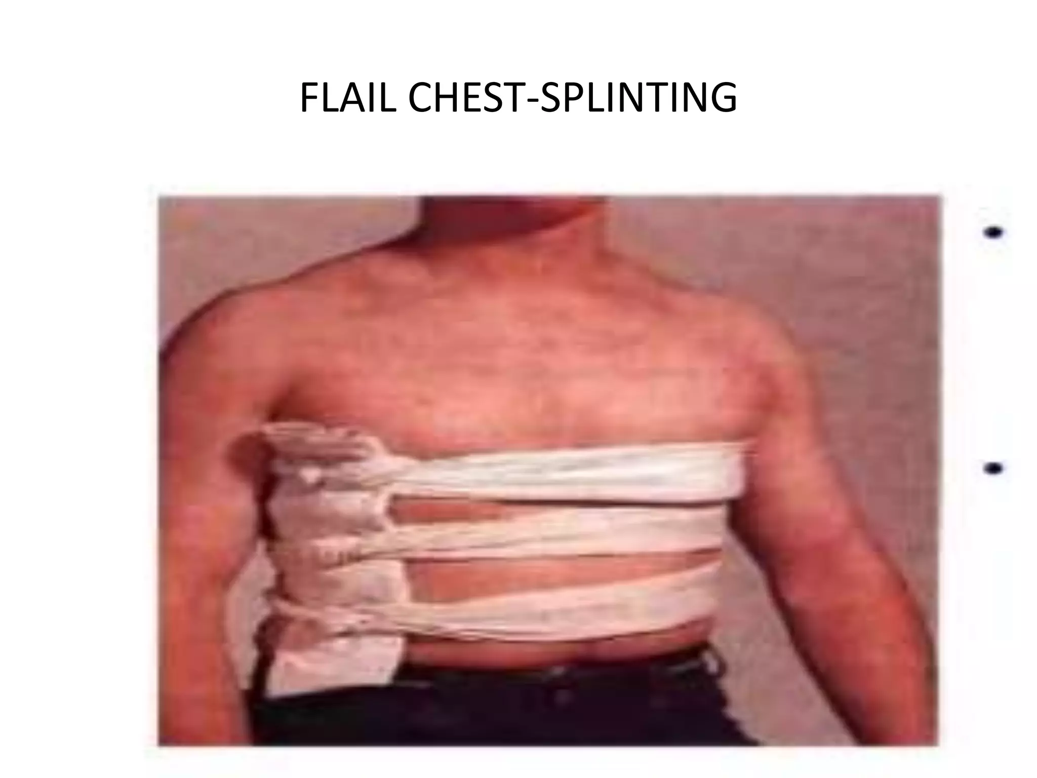 CHEST INJURIES.pptx