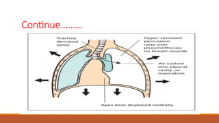 Chest injuries, complications and management pptx | PPT