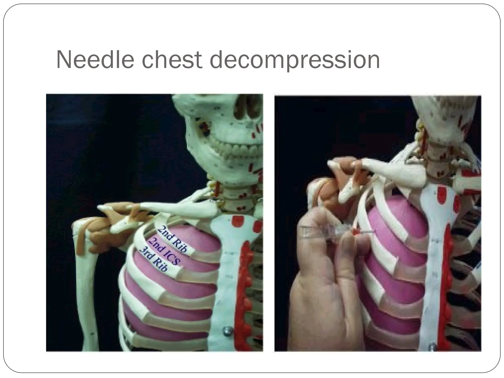 Chest injuries.ppt in surgery rotation 4.2 | PPT