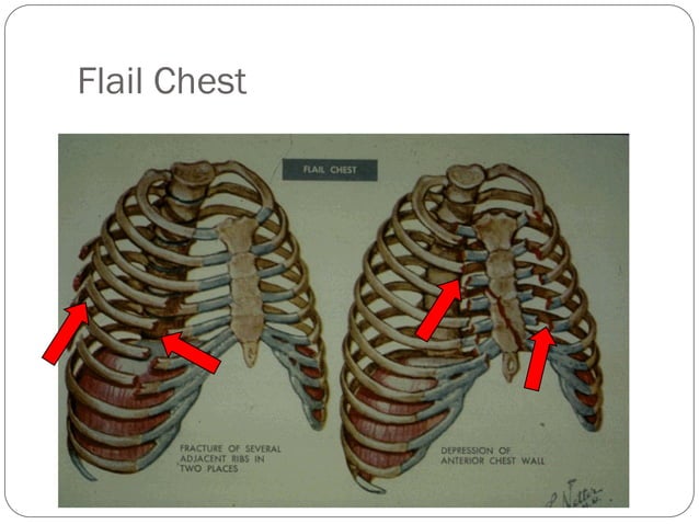 Chest injuries.ppt in surgery rotation 4.2 | PPT