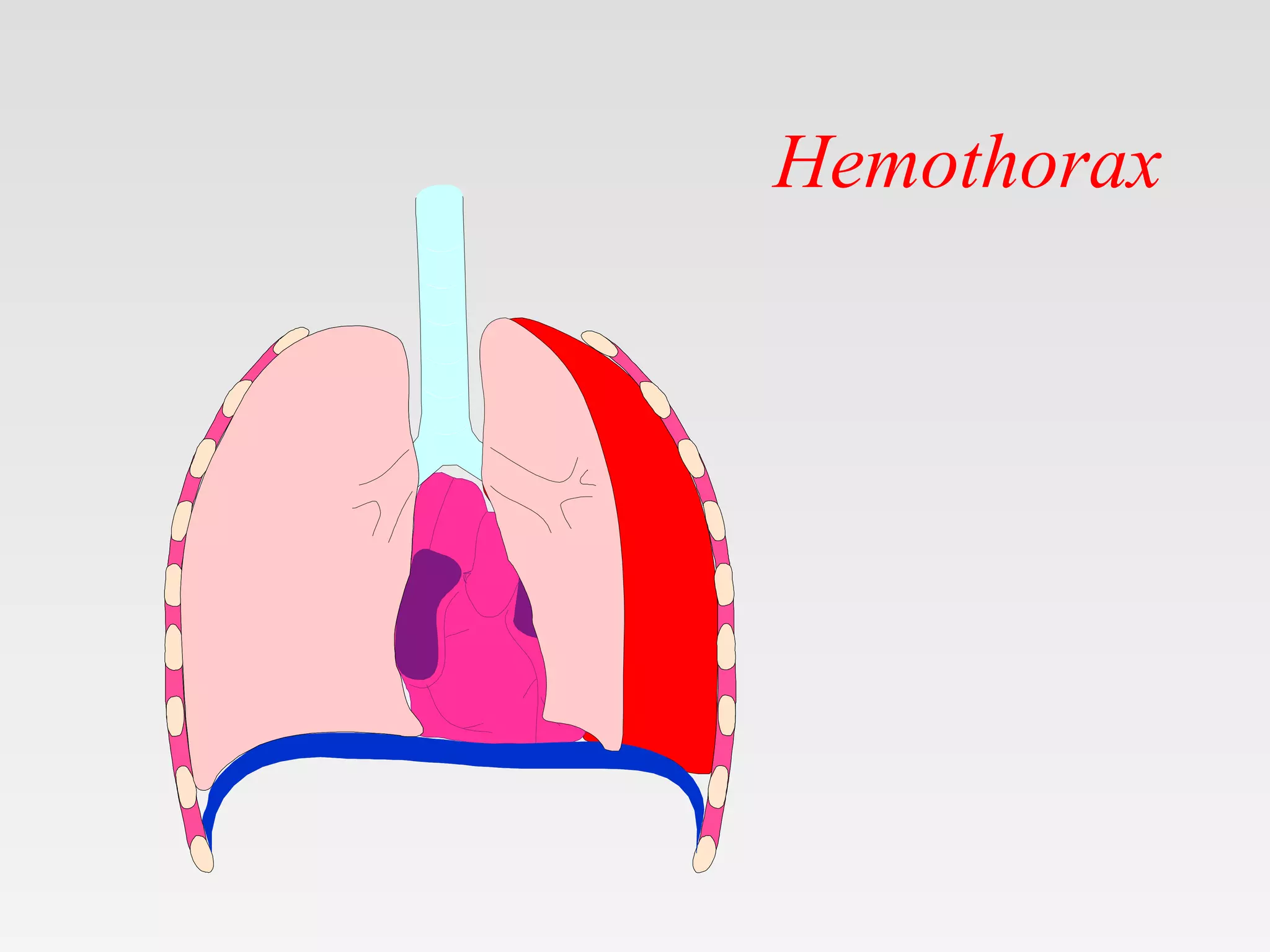 Chest injuries and hemothorax.pptx