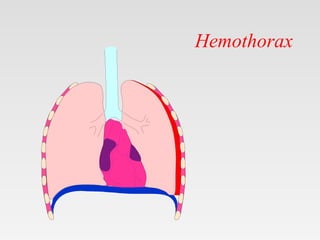 Chest injuries and hemothorax.pptx