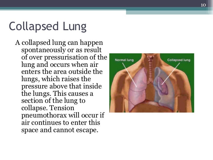 Chest Injuries