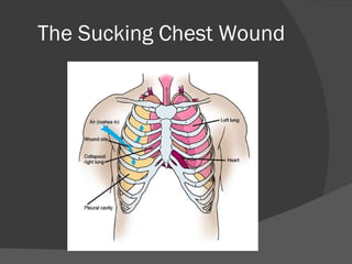 Chest injuries ppt 97 | PPT