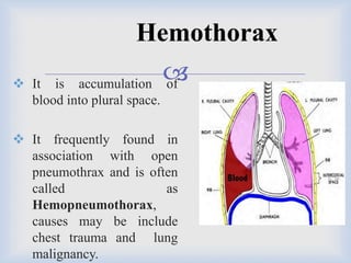 Chest injury | PPTX