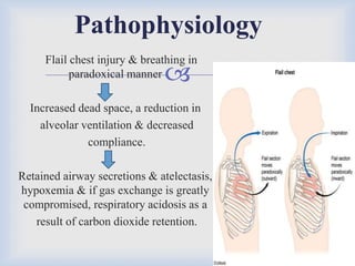 Flail Chest Diagram