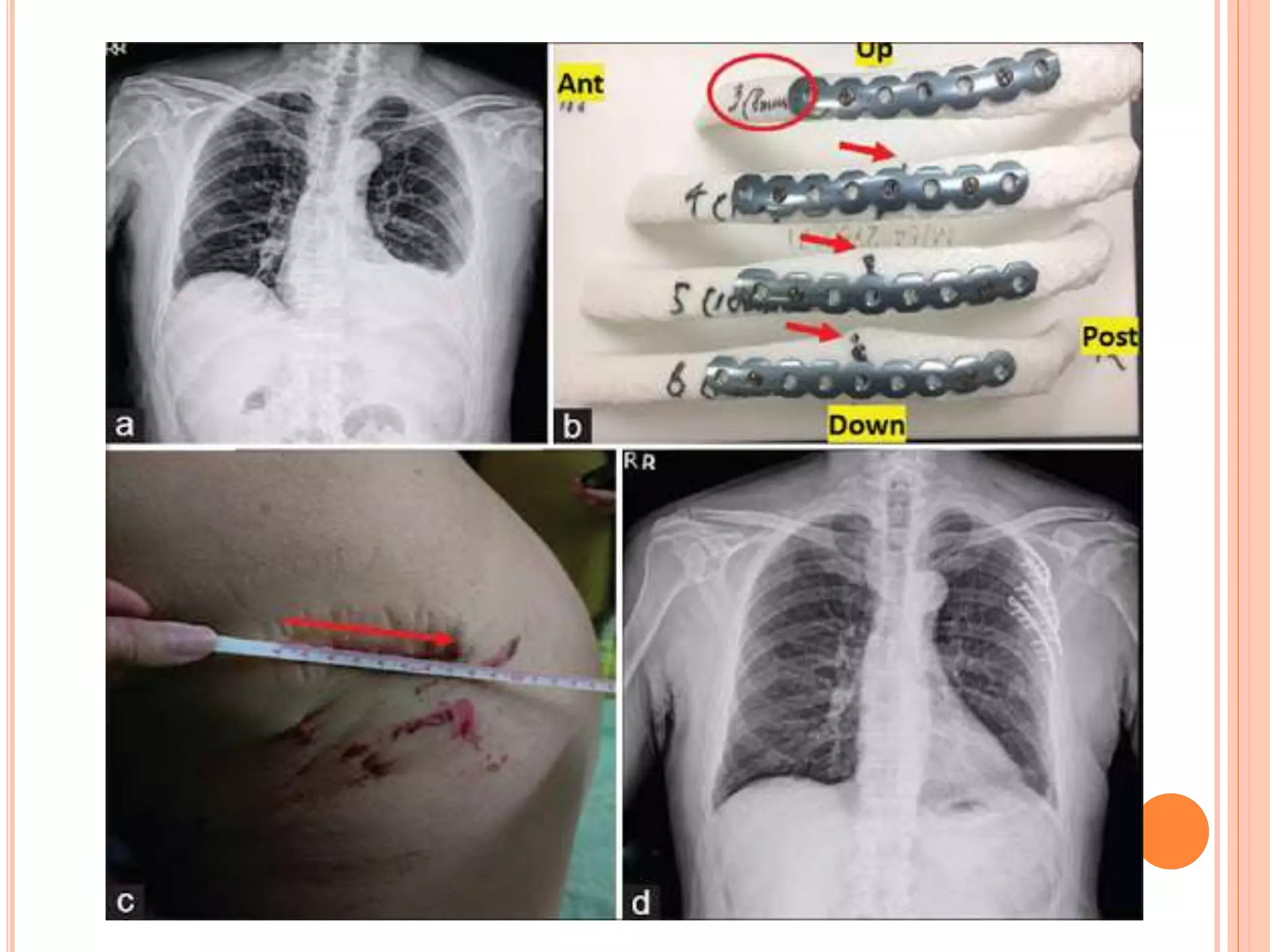 Chest injury and nursing care | PPTX