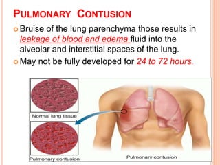 Chest injury and nursing care | PPTX