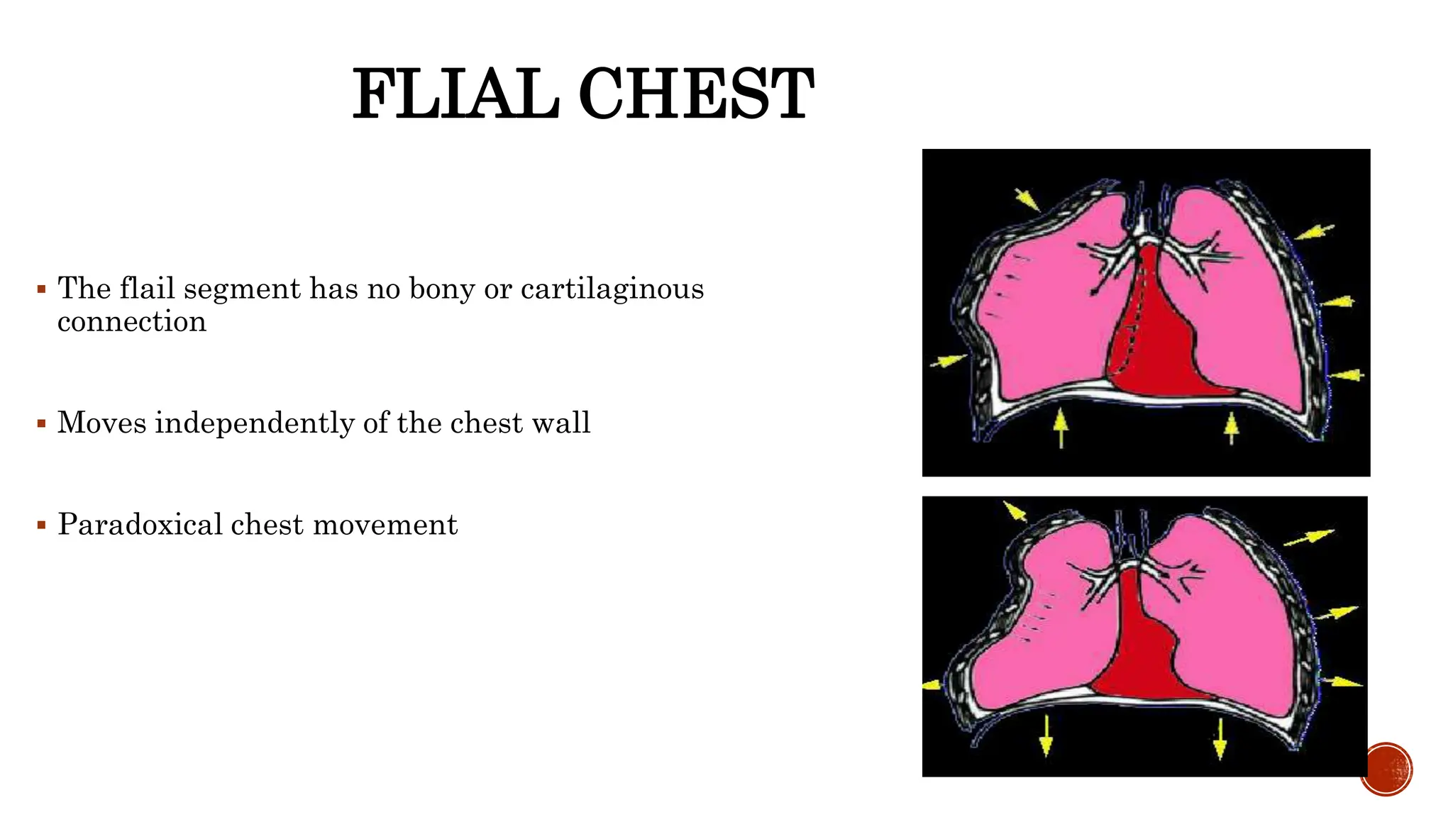 chest injury.pptx, hemothorax# pneumothorax # management | PPTX