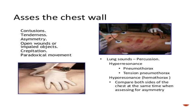 chest injury.pptx, hemothorax# pneumothorax # management | PPT