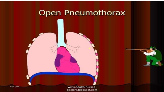 chest injury.pptx, hemothorax# pneumothorax # management | PPTX
