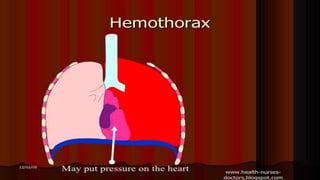 chest injury.pptx, hemothorax# pneumothorax # management | PPTX