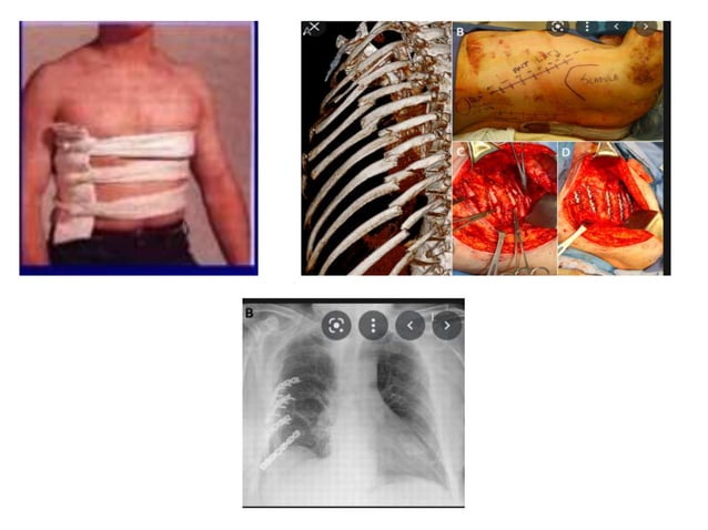 Chest injuries and related medical conditions.pptx