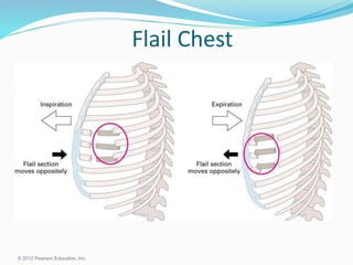 Chest injury.ppthfdsghjbvfvvbbbjjjhvdsdg | PPT