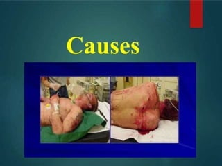 chest injury.powerpoint presentation..... | PPTX