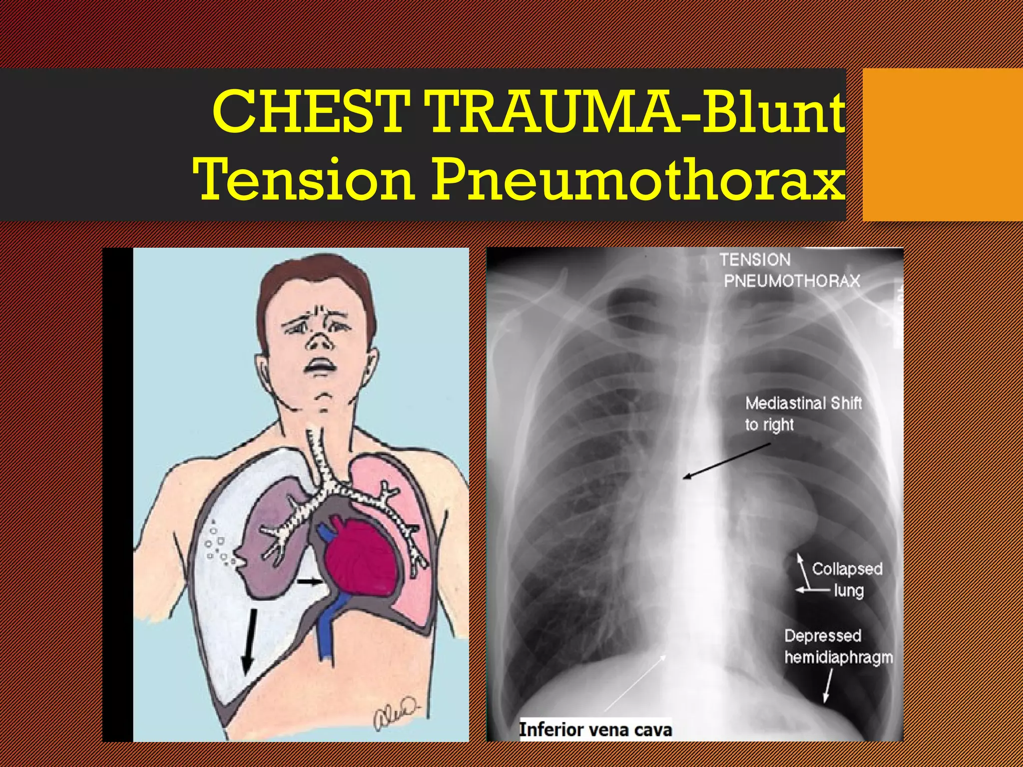 CHEST INJURY- BLUNT- Trauma Surgery | PPT