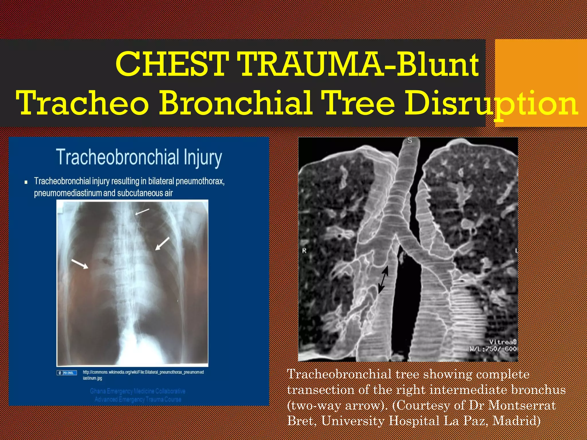 CHEST INJURY- BLUNT- Trauma Surgery | PPT