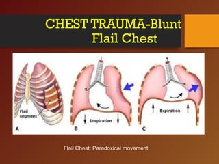 CHEST INJURY- BLUNT- Trauma Surgery | PPT