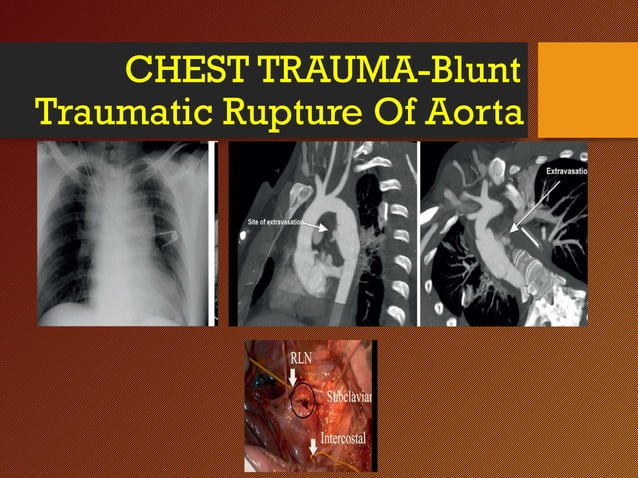CHEST INJURY- BLUNT- Trauma Surgery | PPT | Death, Injury, or Military ...