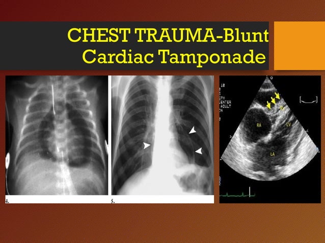 Blunt Trauma Related Chest Wall And Pulmonary Injuries: An Overview – RKIF