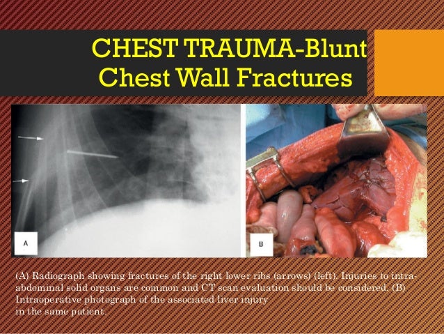 CHEST INJURY- BLUNT- Trauma Surgery