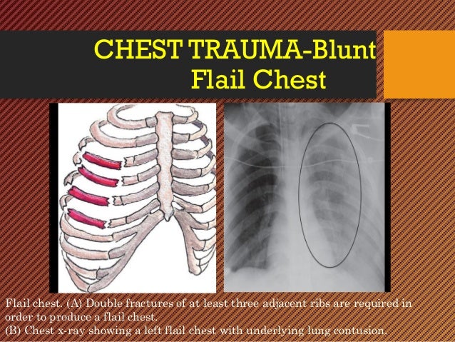 CHEST INJURY- BLUNT- Trauma Surgery