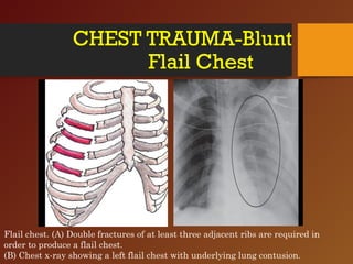 chestinjury-blunt-180324031430 (1).pdf
