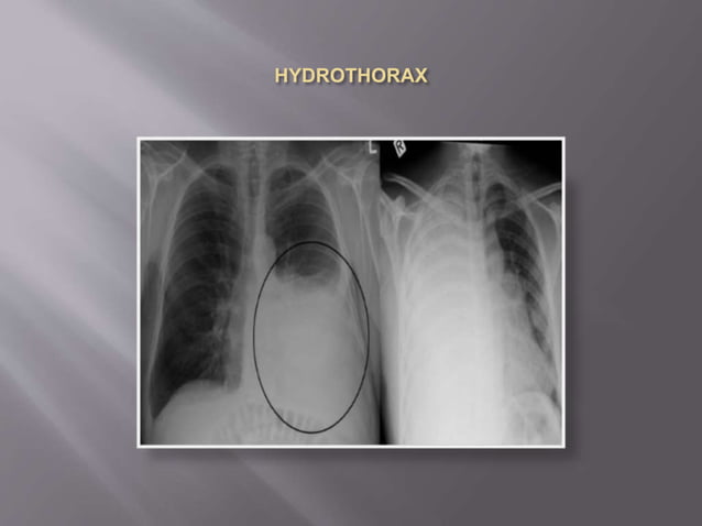 Chest intubation indications,precautions and management | PPTX