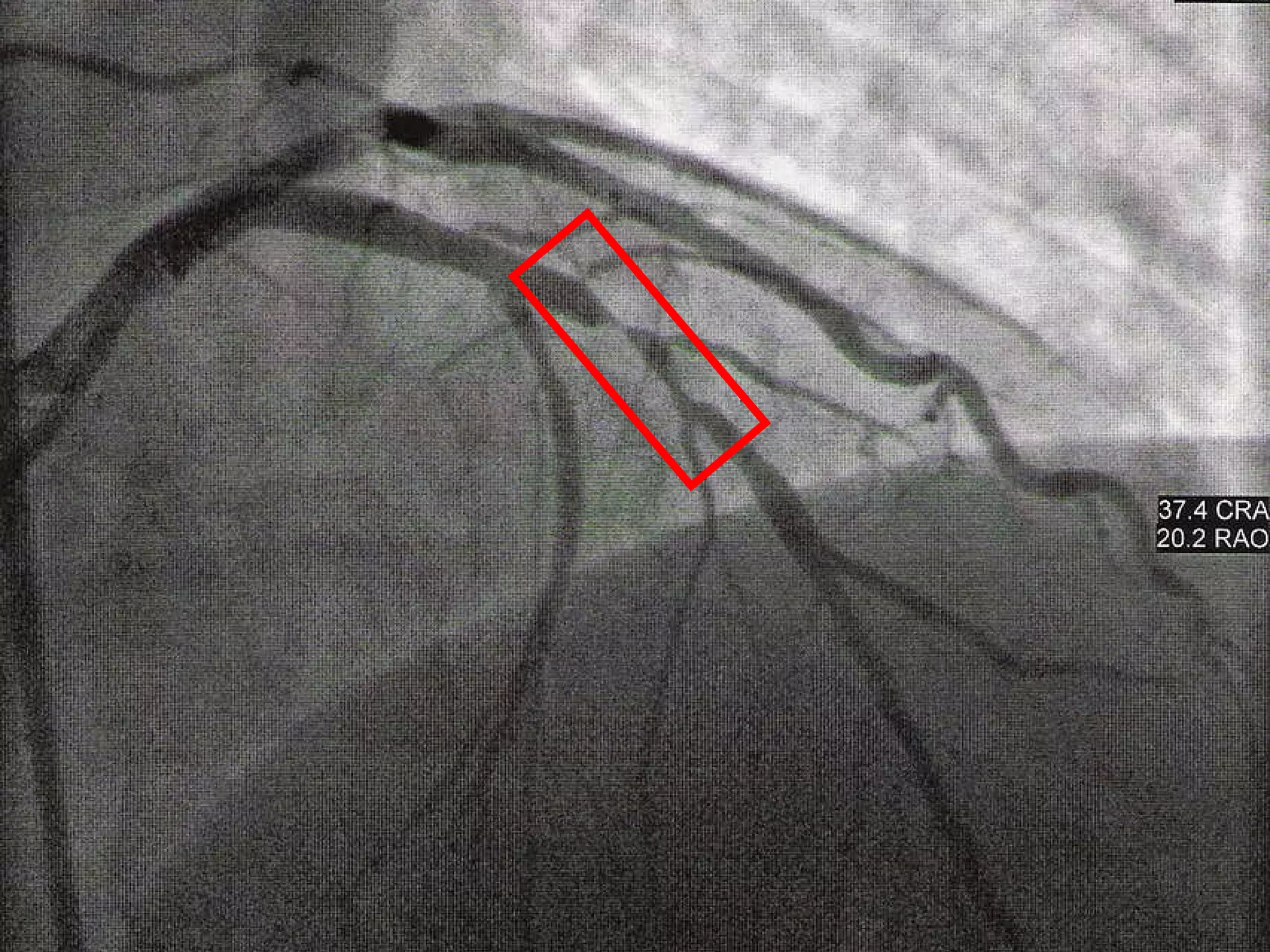Chest pain: nursing assessment and management | PPT