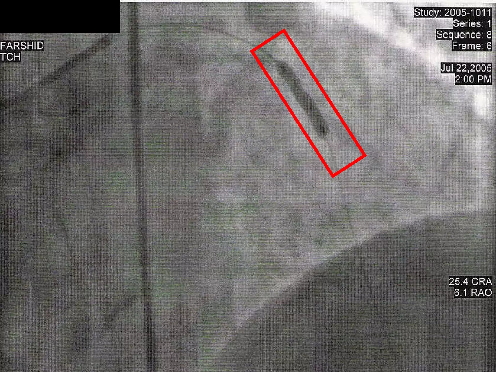 Chest pain: nursing assessment and management | PPT