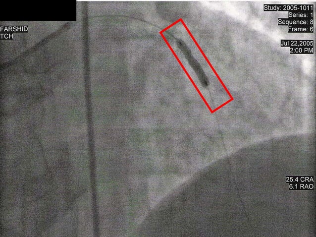 Chest pain: nursing assessment and management | PPT
