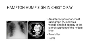 Chest pain | PPTX