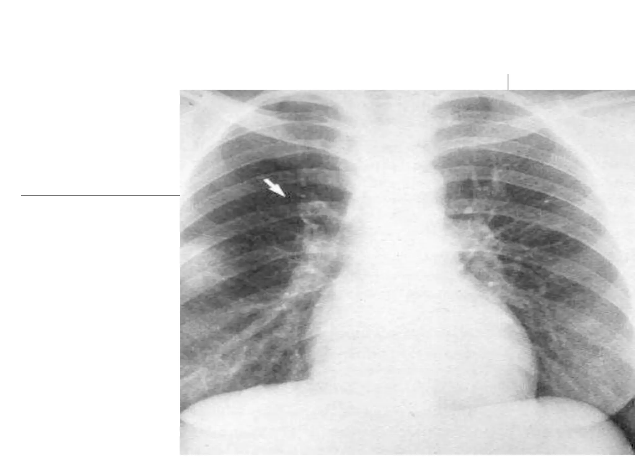 Chest Pain.ppt
