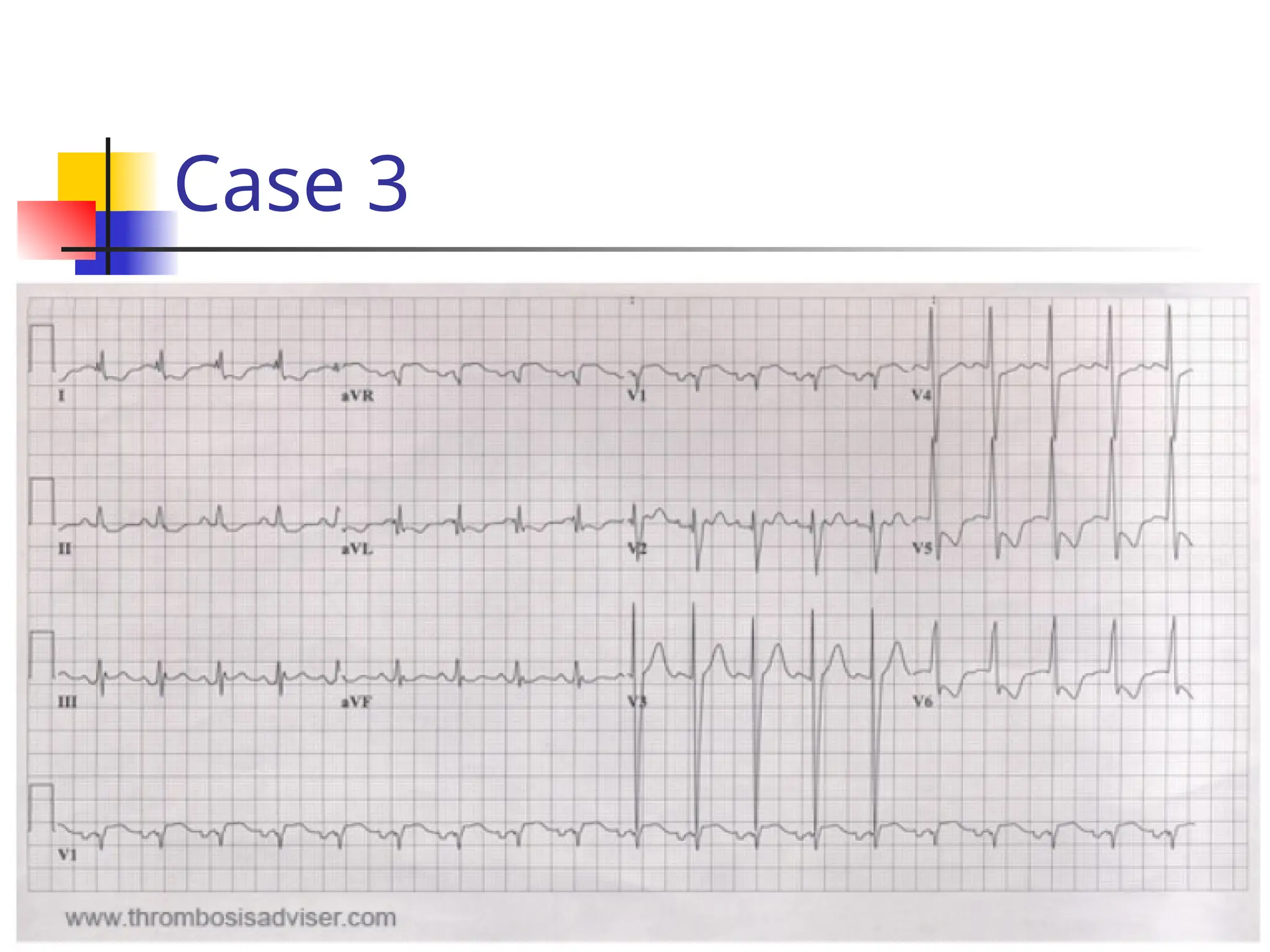chest pain. Emergency department appraoch | PPT