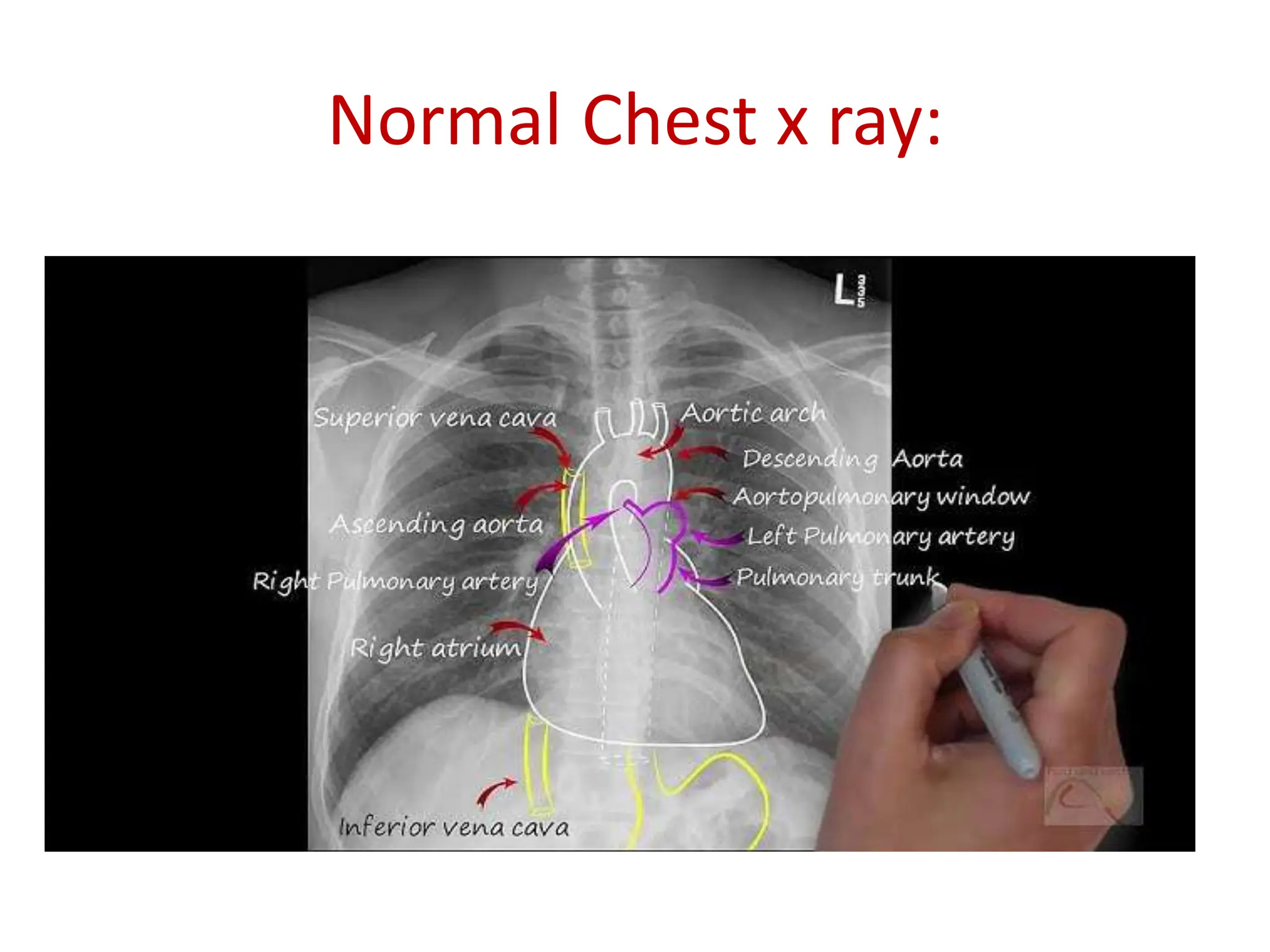 Differential diagnosis of chest pain .pptx