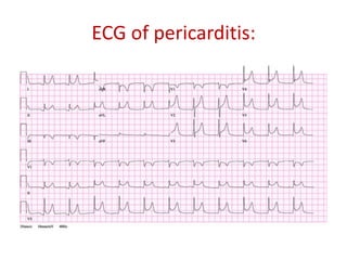 Differential diagnosis of chest pain .pptx