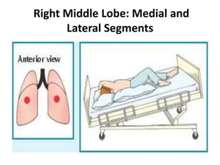 Chest physiotherapy, | PPT