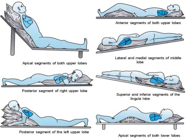 Chest physiotherapy in ICU