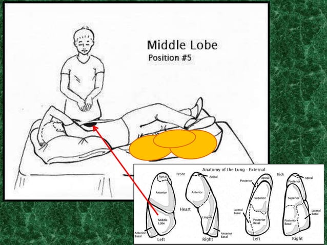 CHEST PHYSIOTHERAPY & POSTURAL DRAINAGE | PPTX | Physical Therapy ...