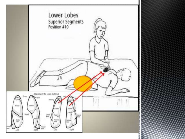 CHEST PHYSIOTHERAPY & POSTURAL DRAINAGE | PPTX | Physical Therapy ...