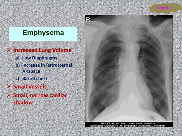 Interpretation of Chest X-Ray with a few common disease | PPTX