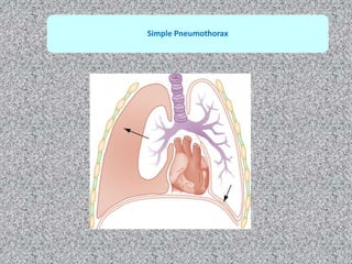 Interpretation of Chest X-Ray with a few common disease | PPTX