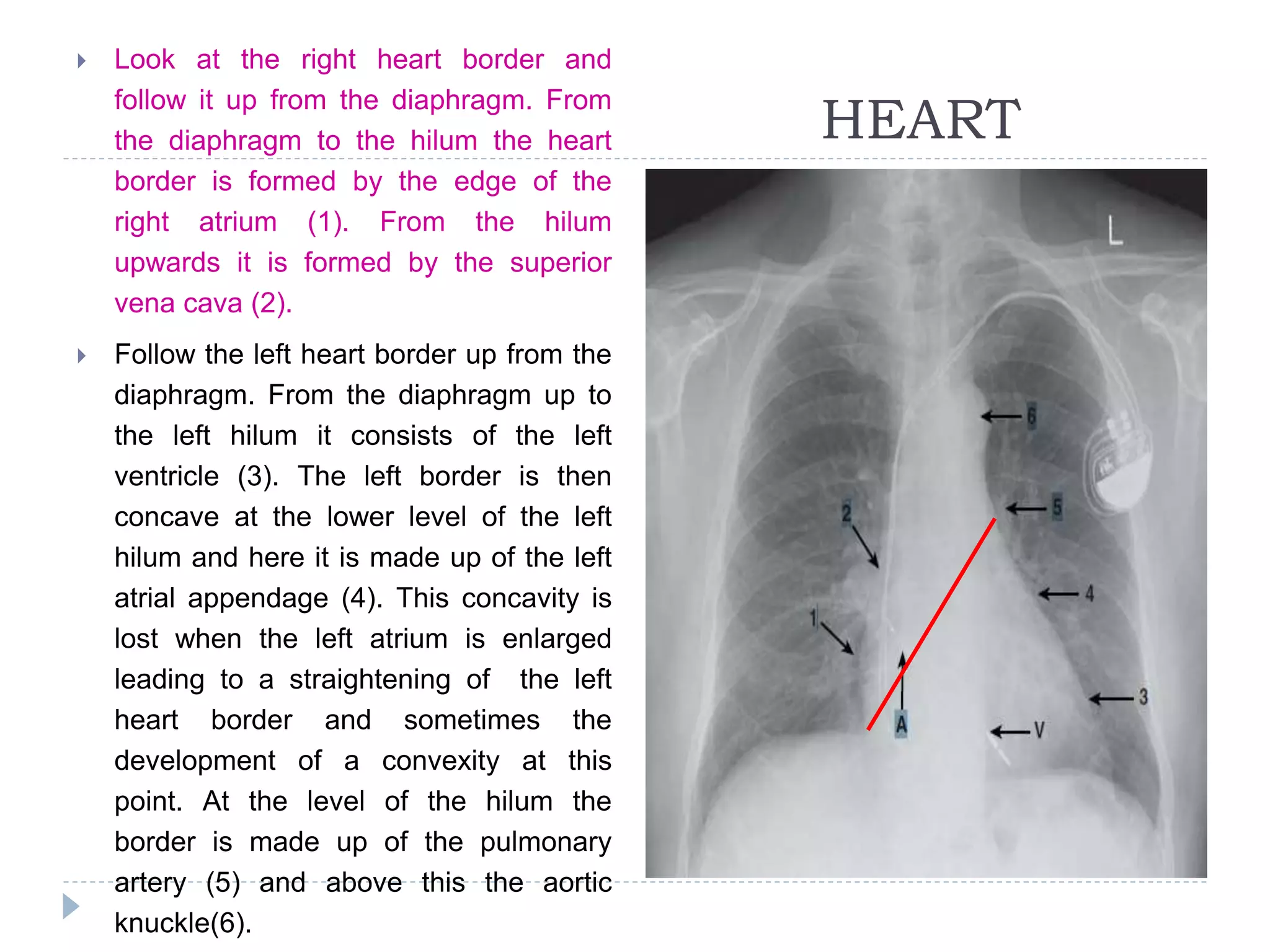 Chest radiograph | PPTX