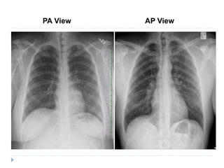 Chest radiograph | PPTX