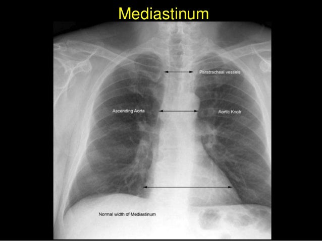 Chest radiography