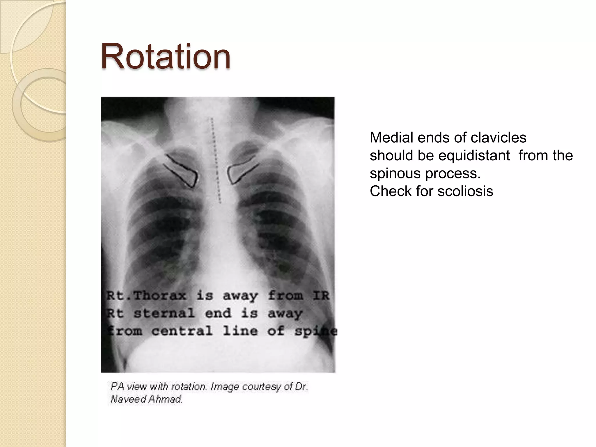 Chest radiography introduction | PPTX