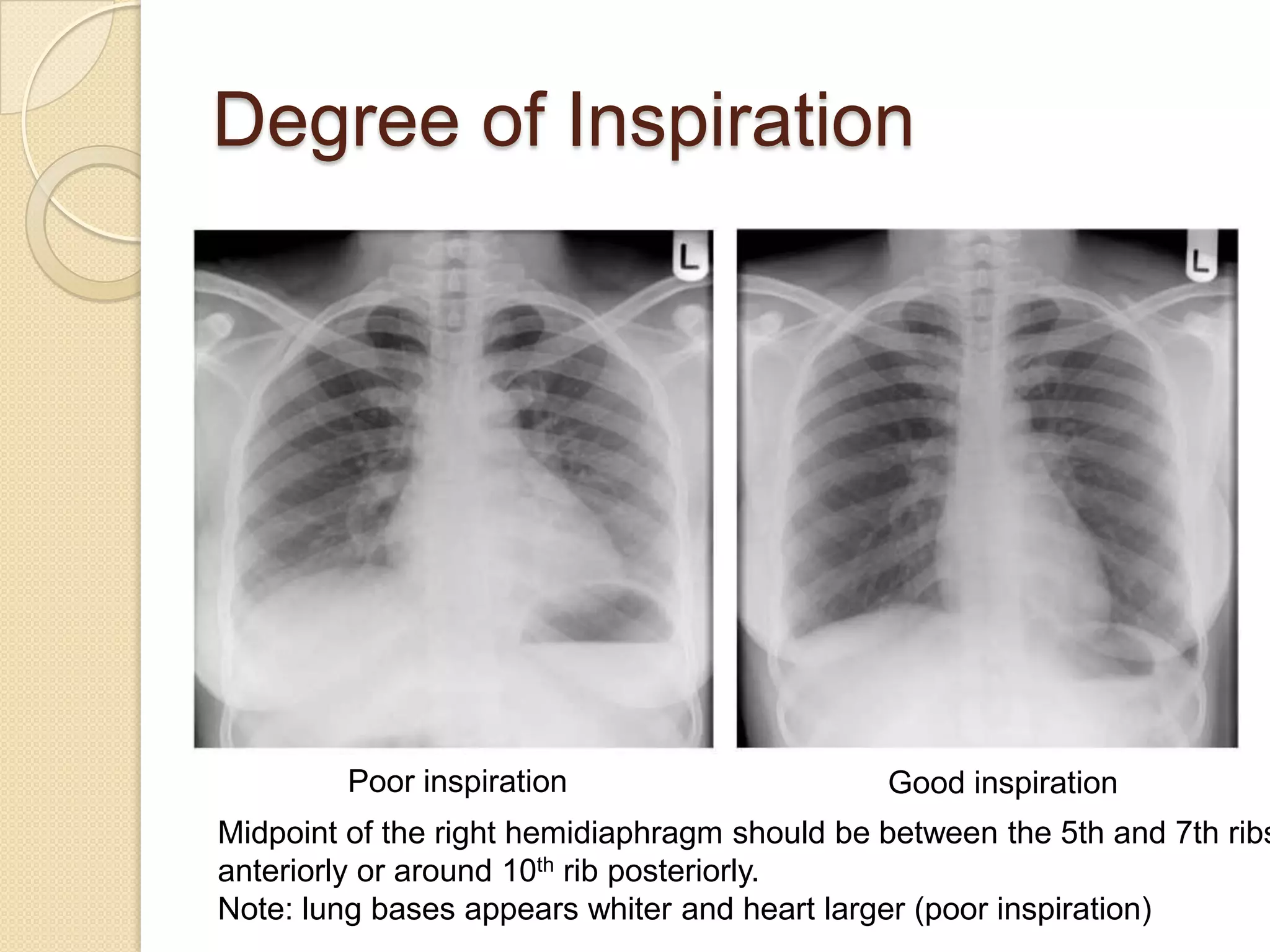 Chest radiography introduction | PPTX