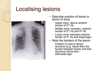 Chest radiography introduction | PPTX