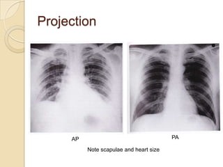 Chest radiography introduction | PPTX | Lung and Respiratory Health ...